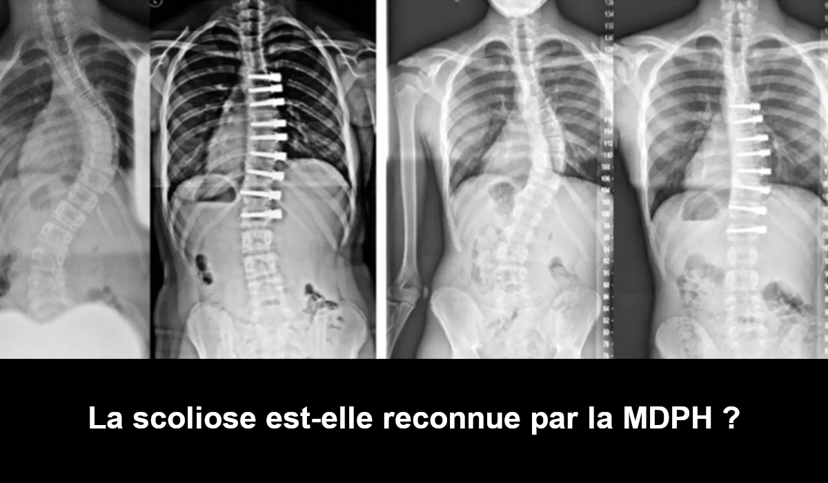 La scoliose est-elle reconnue par la MDPH